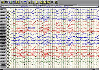 Electroencephalography (EEG) - Hammersmith Medicines Research